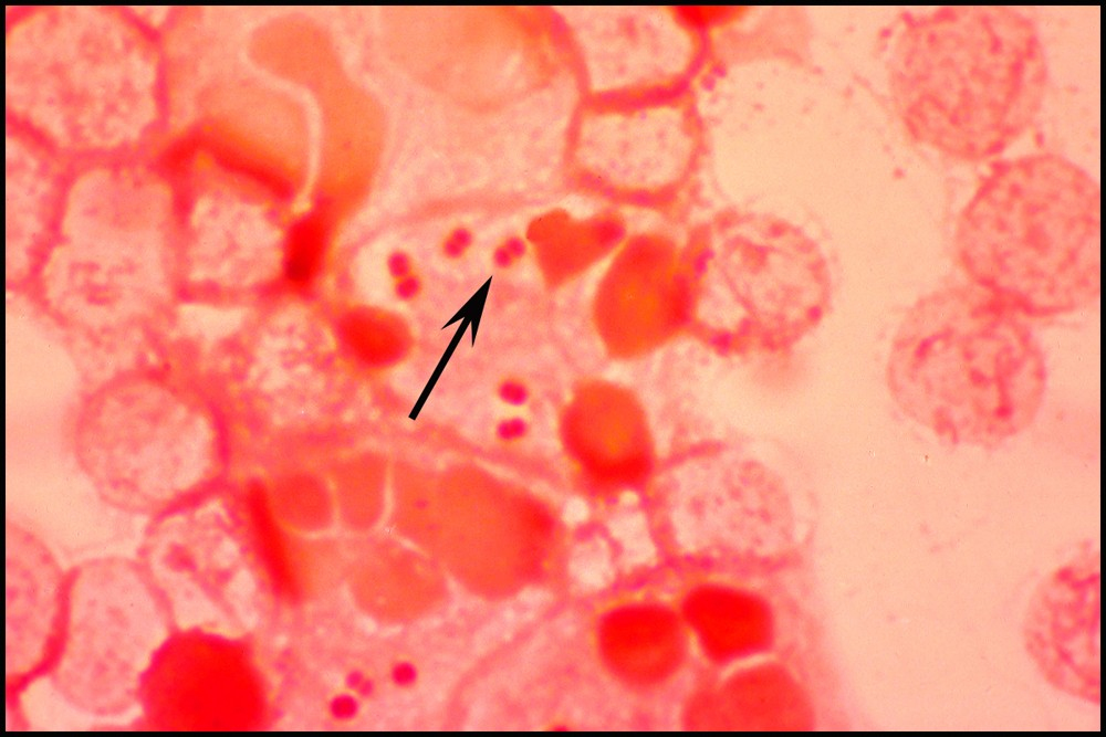 Lo que usted debe saber sobre la meningitis meningocócica Lo que usted debe saber sobre la meningitis meningocócica